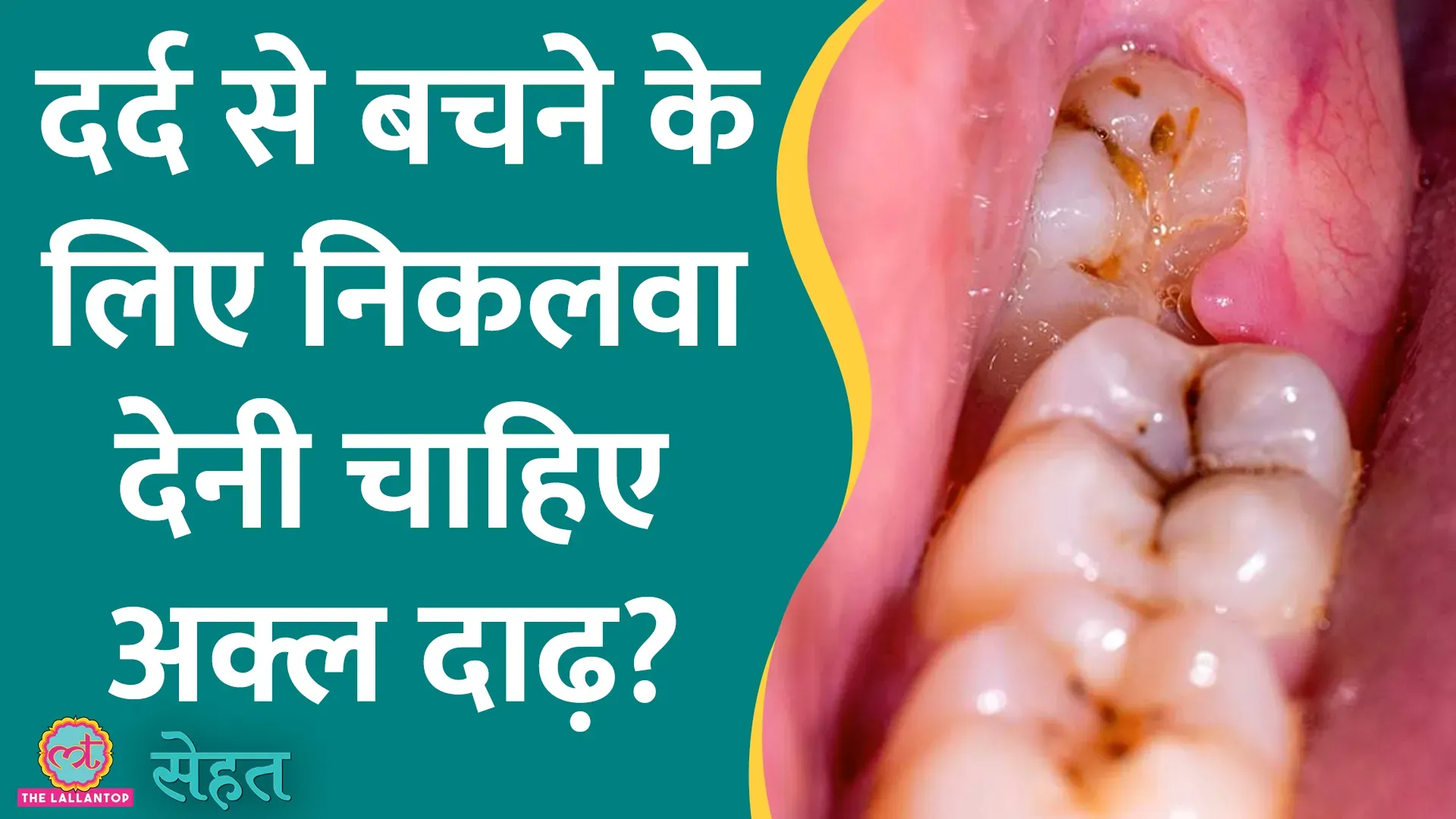 सेहत: विसडम टीथ यानी अक्ल दाढ़ में इन्फेक्शन का ख़तरा कब होता है? - The ...